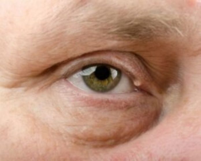 ¿Por qué salen perrillas en los ojos? Estos pueden ser los motivos ...